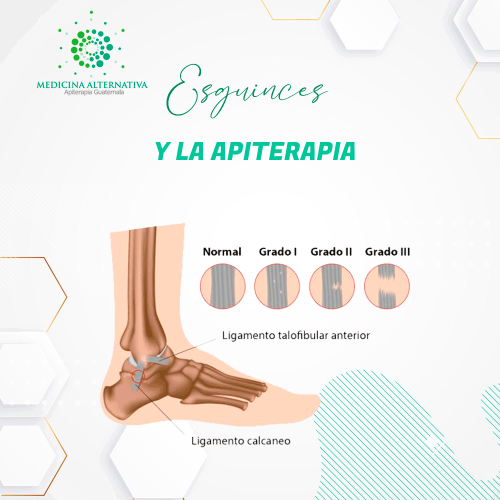 Esguinces - Medicina Alternativa